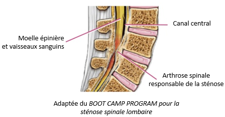 Sténose spinale - Injuries and conditions - Clinique Chiropratique St ...